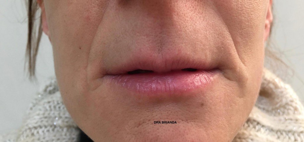 Aumento de labios y rellenos - ácido hialurónico - Málaga y Marbella