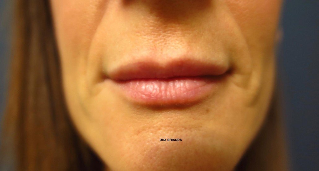 Aumento de labios y rellenos - ácido hialurónico - Málaga y Marbella